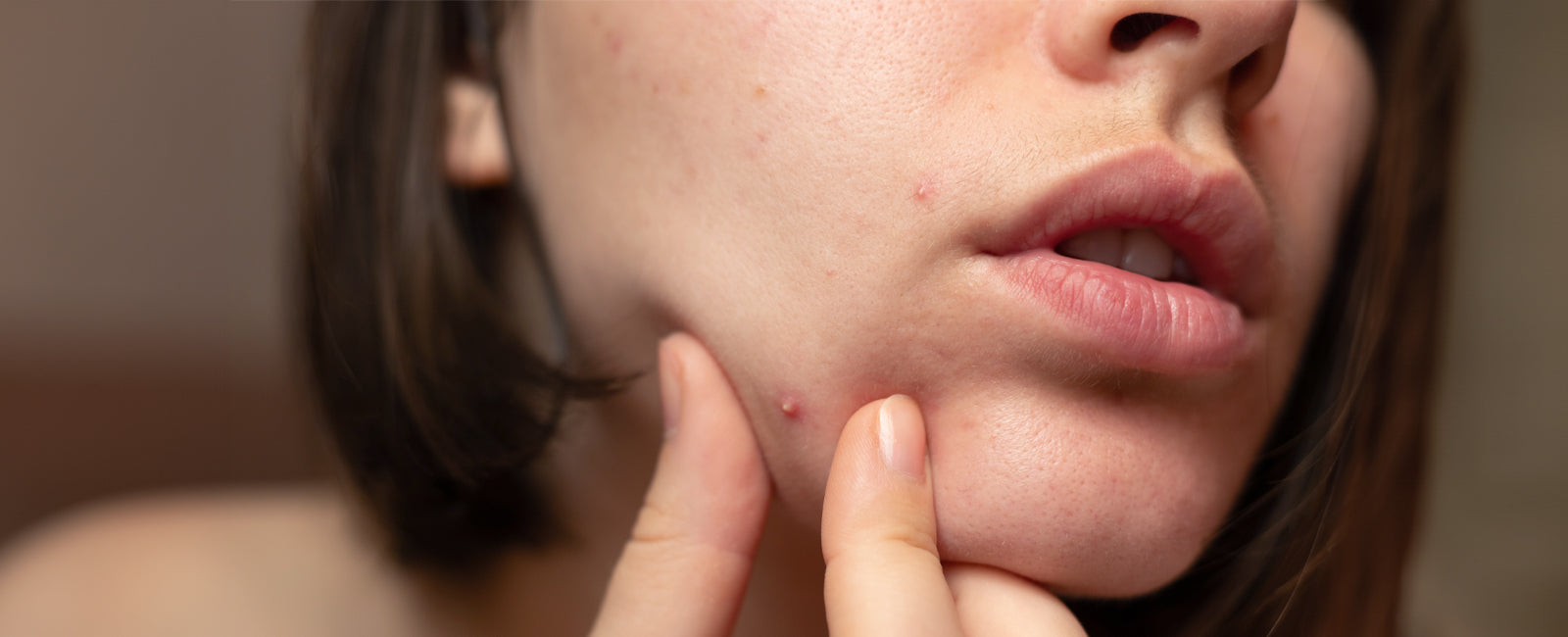 Isotretinoin: Wie man schwere Akne und trockene Haut in den Griff beko ...